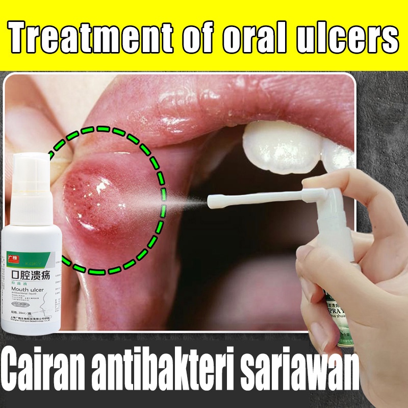 Jual Cairan antibakteri sariawan 30ml Obat sariawan anak Obat gusi ...