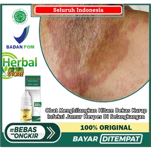 Jual Obat Penghilang Gatal, Gatel,- Menghilangkan Hitam Bekas Kurap ...