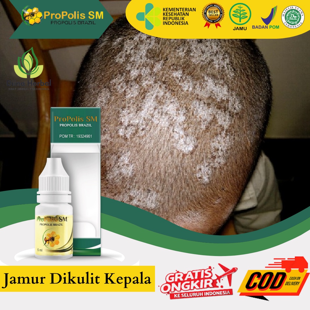 Jual Obat Tinea Capitis, Obat Infeksi Jamur DiKepala, Obat Gatal Kulit Kepala, Obat Kulit Kepala ...