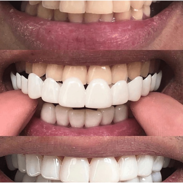 Jual VENEER GIGI PALSU SNAP ON SMILE GIGI PALSU VIRAL GIGI PALSU ...