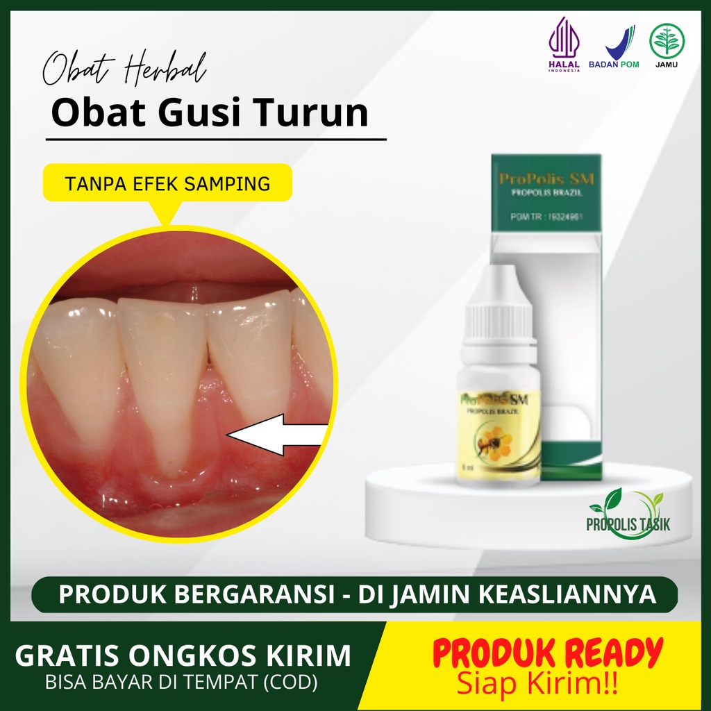 Jual Obat Gusi Turun Gingiva Gusi Turun / Menyusut, Akar Gigi Telihat ...