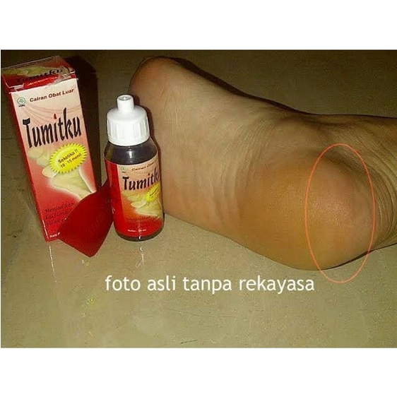 Jual TUMITKU (CAIRAN OBAT LUAR UNTUK KAKI PECAH-PECAH) - 30ML | Shopee ...