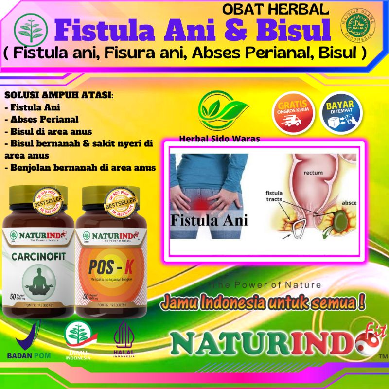 Jual Obat Fistula Fisura Ani Obat Bisul Di Pantat Obat Bisul Herbal ...