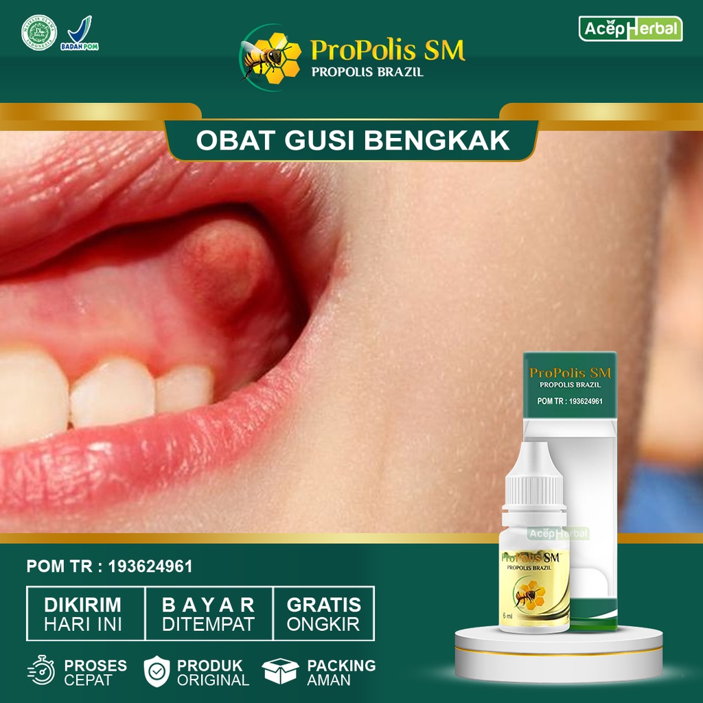 Jual Obat Gusi Bengkak Gusi Berdarah Radang Gusi Perikoronitis Infeksi Bakteri Plak Gigi Bau ...
