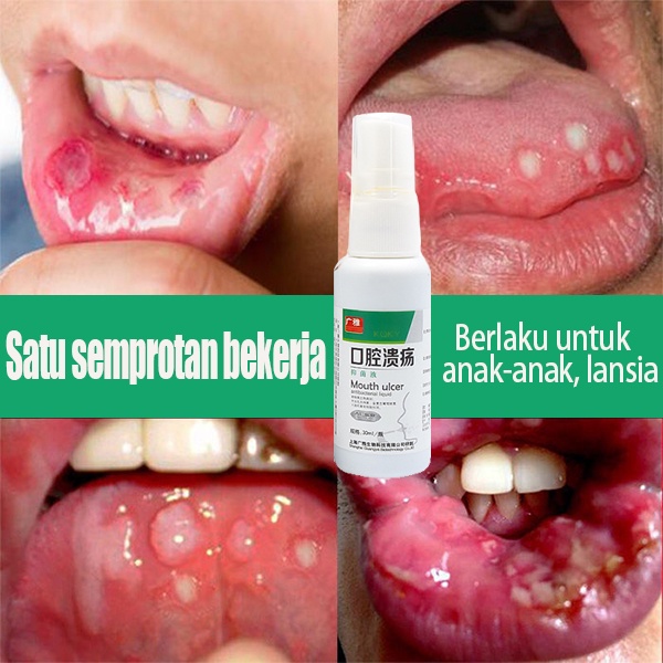 Jual Obat sariawan mulut Obat sariawan anak Obat gusi bengkak 30g ...