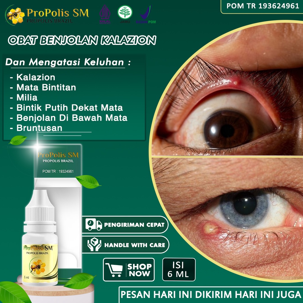 Jual Obat Penghilang Benjolan Kalazion Salep Mata Bintitan Dan Bengkak ...