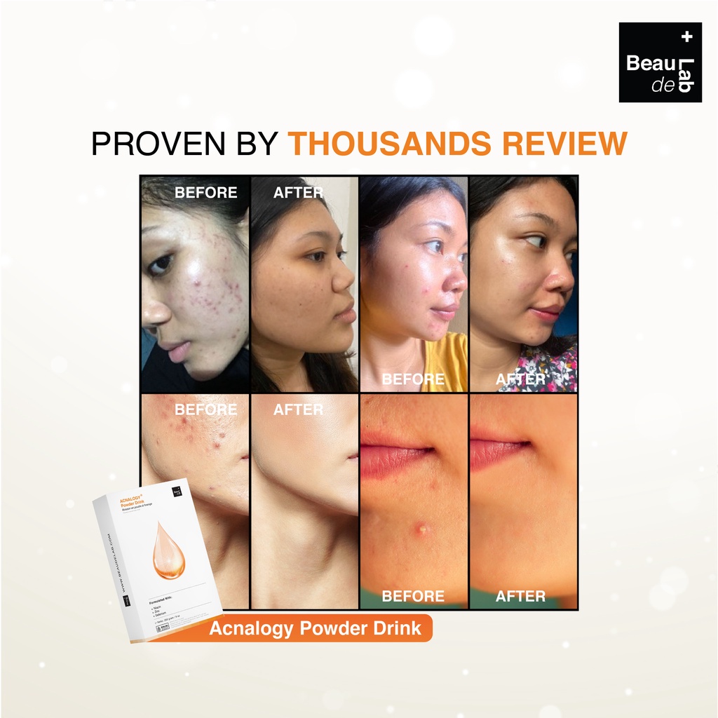 Jual Newlab / Beaudelab Acnalogy Powder Drink | Obat Minum Jerawat ...
