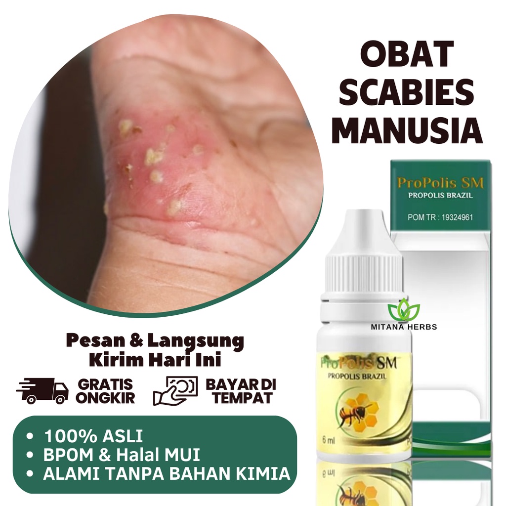 Jual Obat Scabies Manusia, Obat Luka Bernanah Dan Bengkak, Obat Luka ...