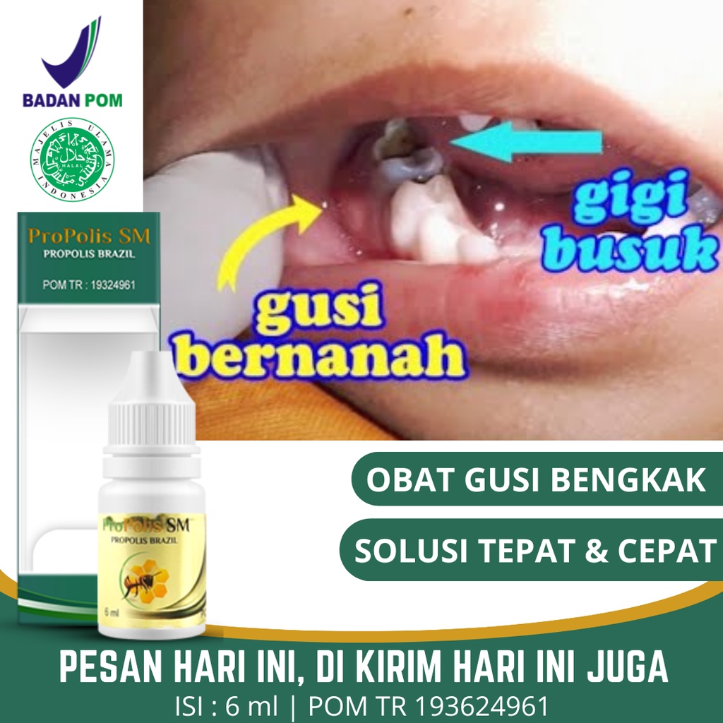 Jual Obat Gusi Bernanah, Gigi Busuk, Nyeri Gusi, Gusi Bengkak, Benjolan ...
