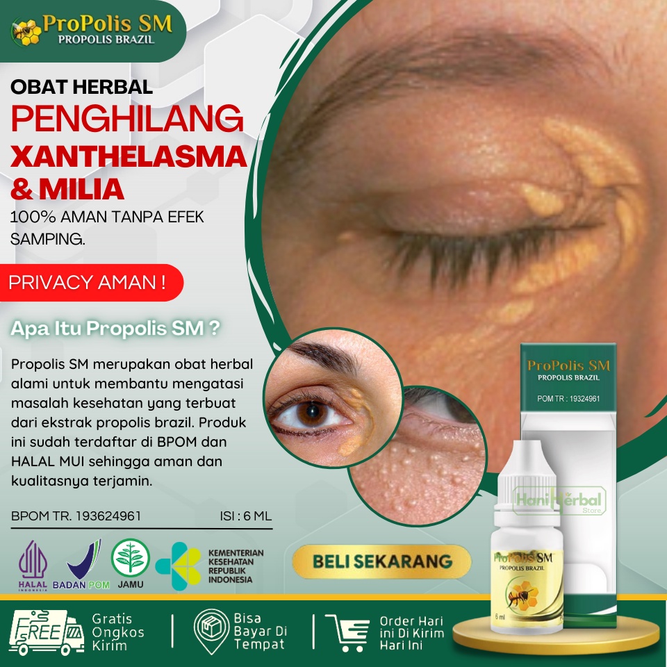 Jual Obat Oles Xanthelasma, Obat Santelasma, Obat Alami Penghilang ...