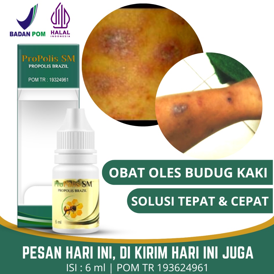 Jual Obat Oles Budug di Kaki, Budug Bernanah & Penghilang Koreng di ...