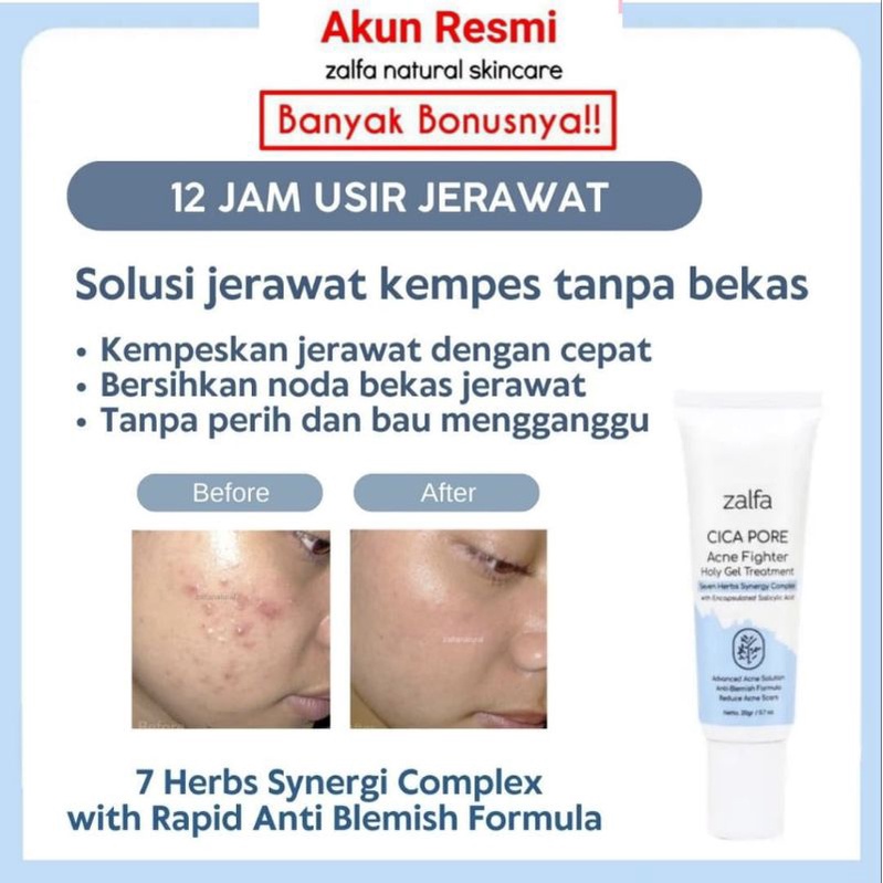 Jual Zalfa Natural Skincare CICA PORE Kemasan baru Acne Gel | Shopee ...