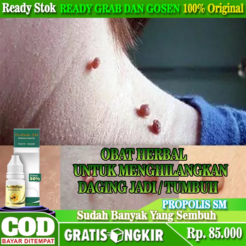 Jual Obat Daging Jadi / Daging Tumbuh Di Kulit Leher, Di Jempol Kaki ...