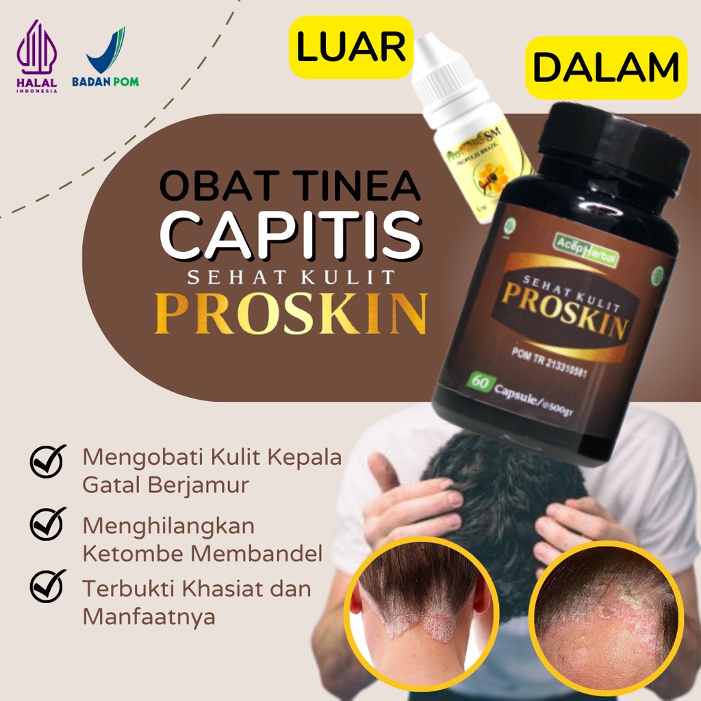 Jual Obat Tinea Kapitis Infeksi Jamur Kulit Kepala Anak dan Dewasa Penghilang Gatal Psoriasis ...