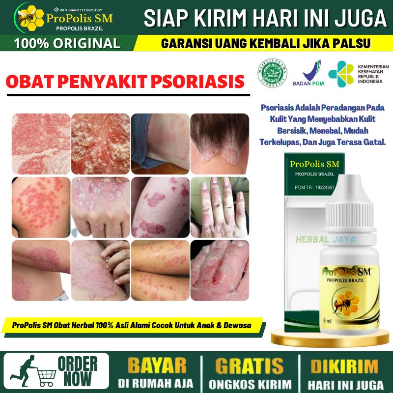 Jual Obat Gatal Psoriasis Selangkangan, Salep Borok di Selangkangan ...