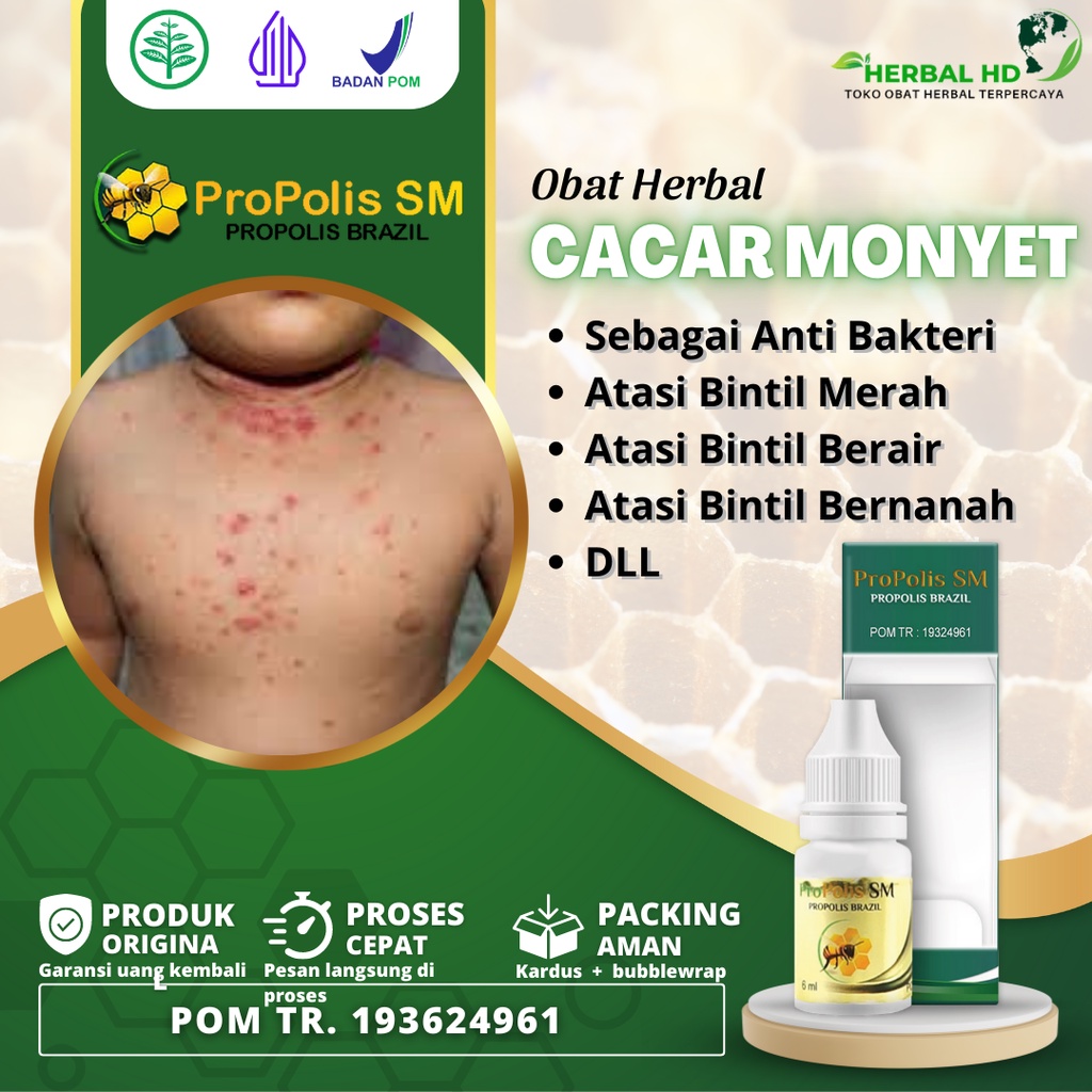Jual Obat Cacar, Obat Cacar Monyet, Obat Cacar Api, Obat Campak, Obat ...