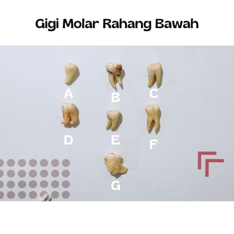 Jual Gigi Molar Rahang Bawah 1 2 3 Gigi Permanen Asli | Gigi kelainan ...