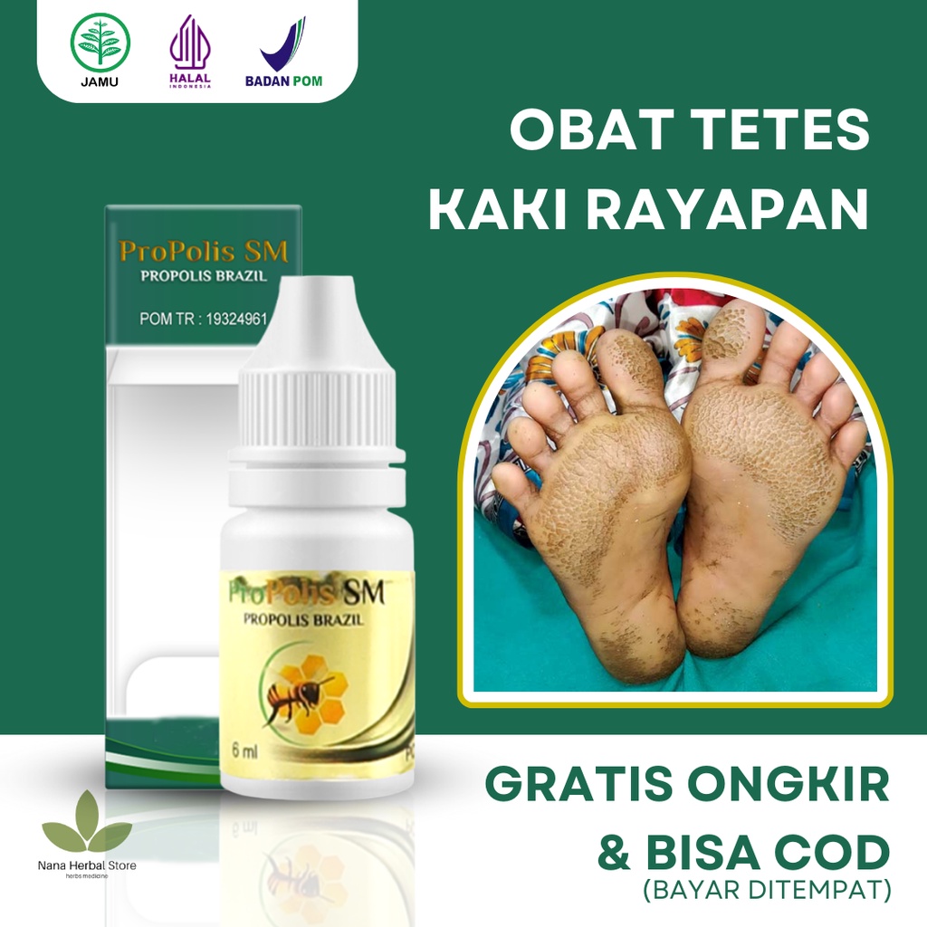 Jual Obat Kaki Rayapan Telapak Kaki Berlubang Telapak Kaki Bolong ...