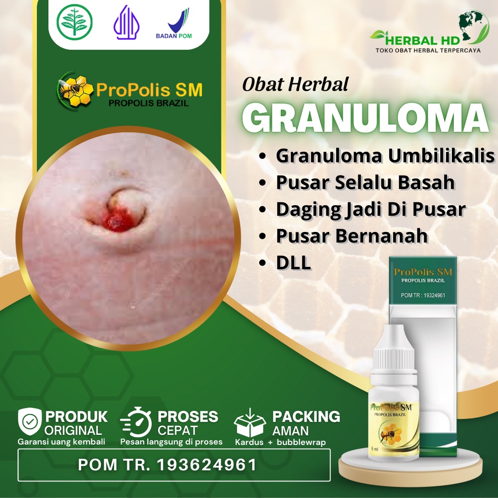 Jual Obat Granuloma umbilikalis, Obat Penghilang Daging Tumbuh Di Pusar ...