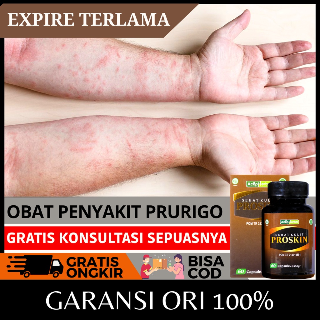 Jual Obat Prurigo Penyakit Darah Manis Penghilang Gatal di Kulit Bintik ...