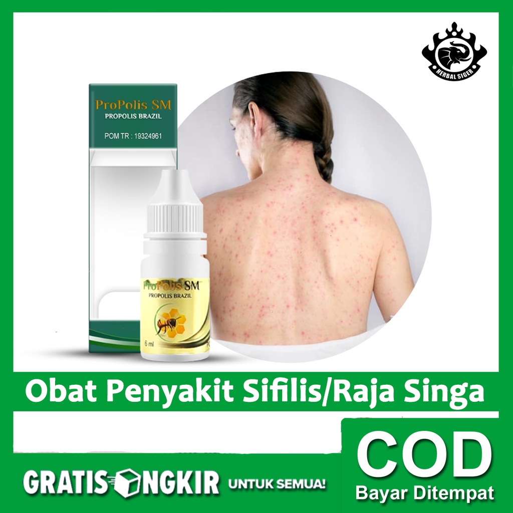 Jual Obat Herbal Sifilis Raja Singa Luka Sifilis di Area Kelamin dan ...