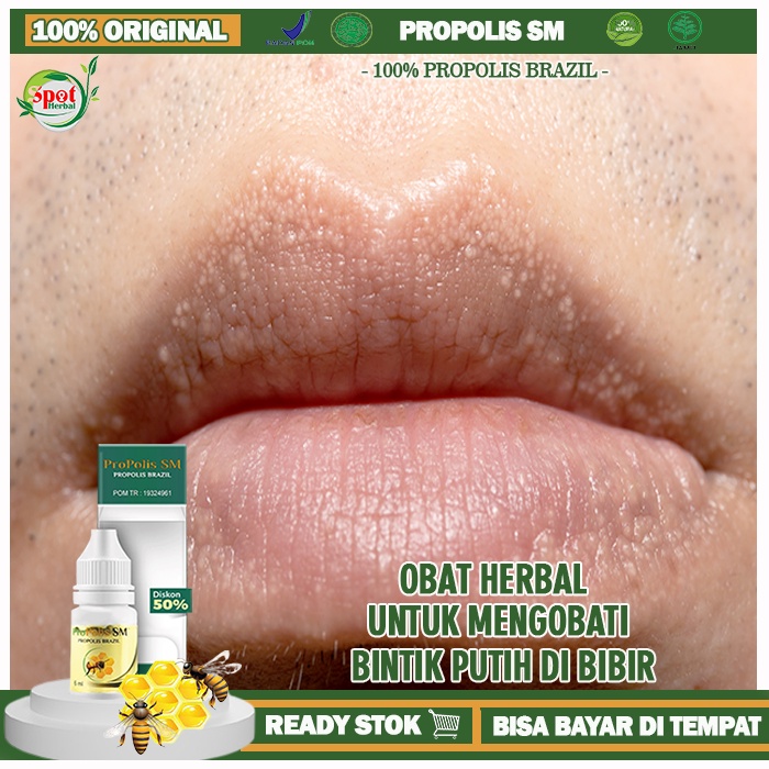 Jual Obat Bintik Putih Dibibir, Obat Milia Di Bibir, Obat Herbal Milia ...