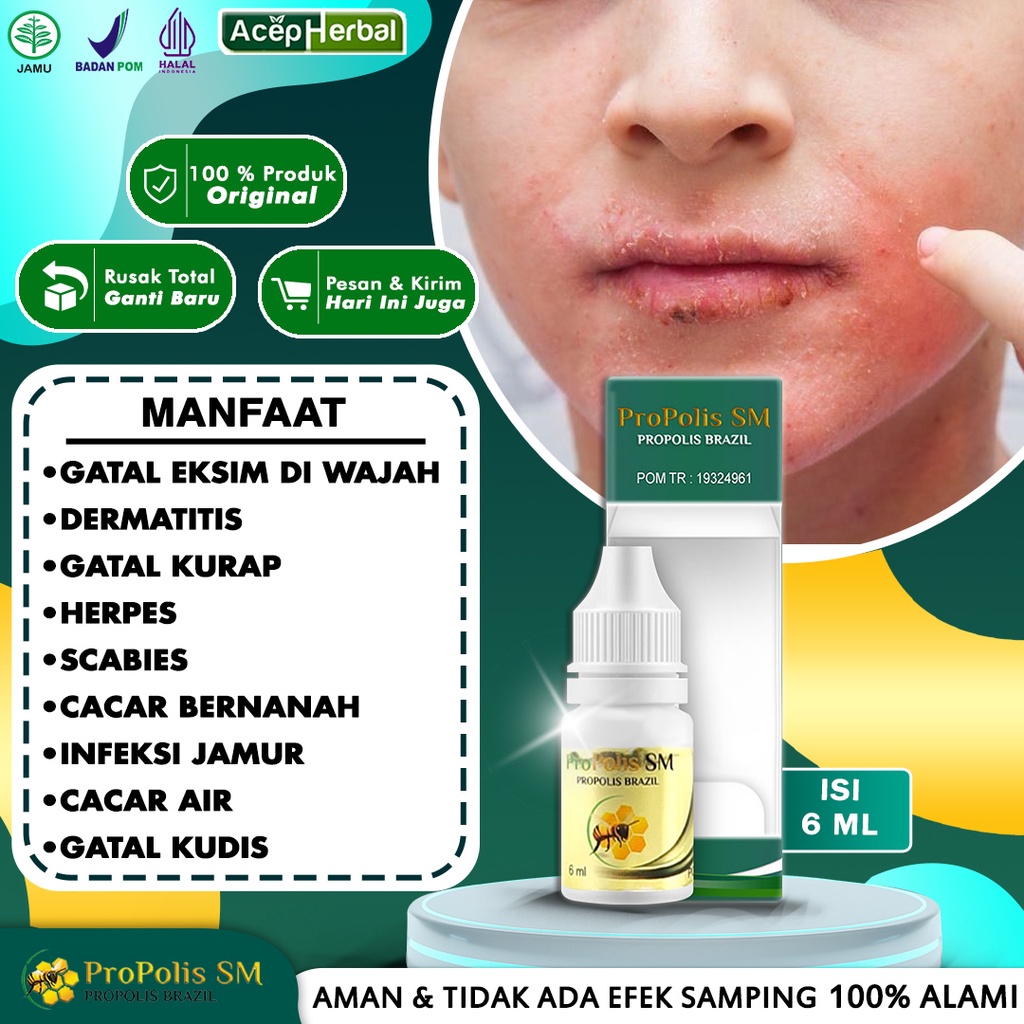 Jual Obat Gatal Eksim di Wajah Leher Telinga Pergelangan Tangan Siku ...