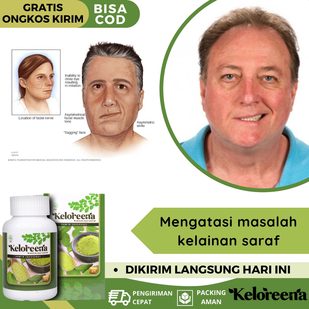 Jual Obat Bells Palsy Obat Wajah Mencong Sebelah Obat Kelumpuhan Otot Wajah Sebelah Obat