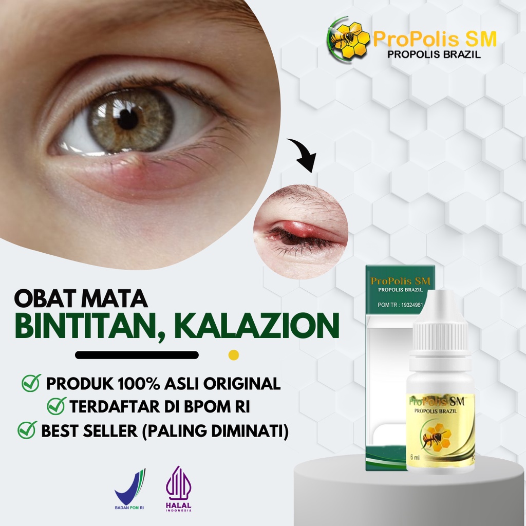 Jual Obat Mata Bintitan - Kalazion - Benjolan Kelopak Mata Propolis SM ...