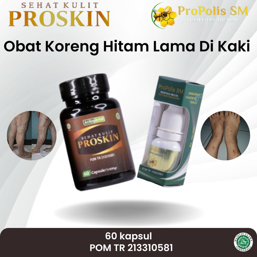 Jual Obat Penghilang Bekas Luka Koreng Hitam Lama Di Kaki, Luka Lama ...