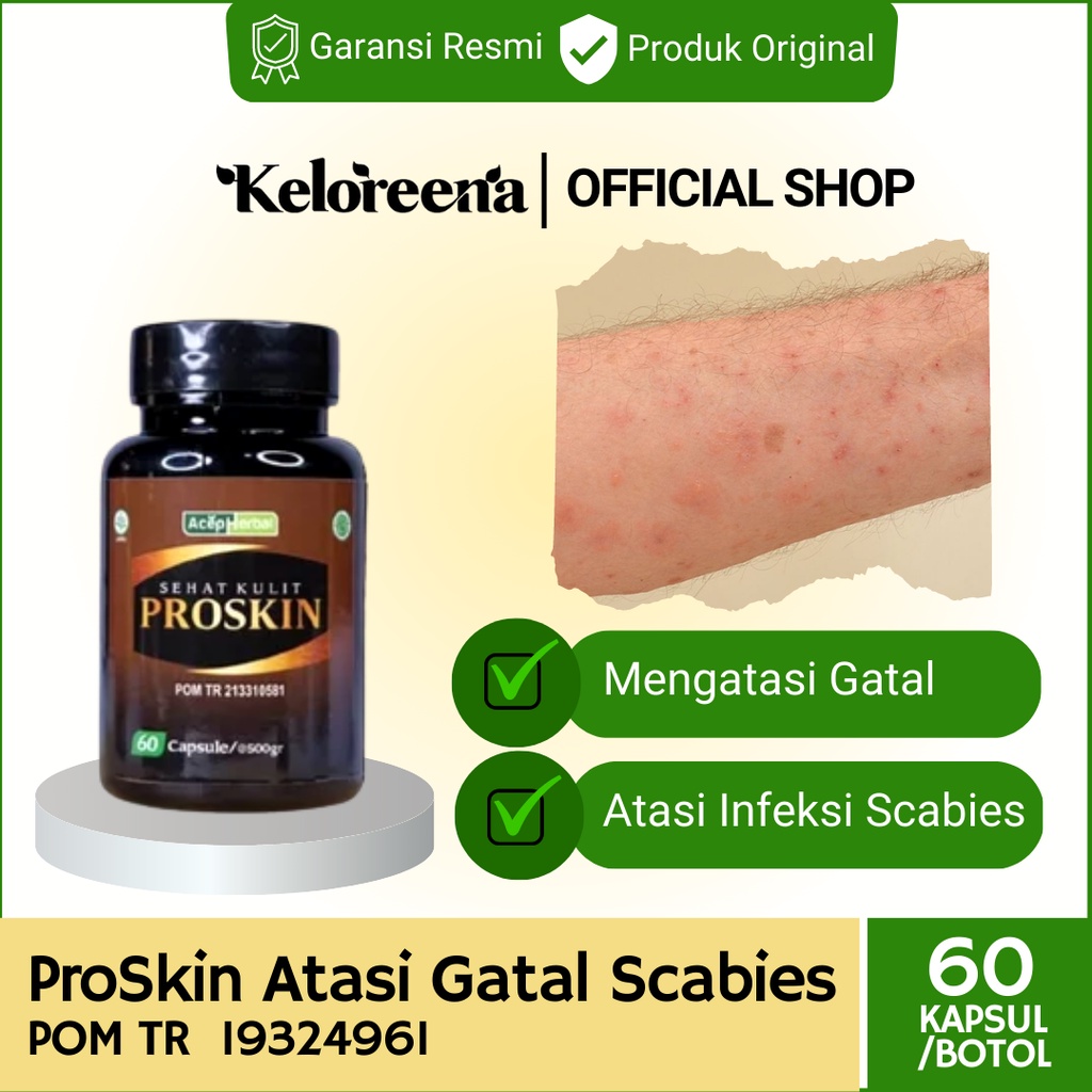 Jual Obat Scabies Manusia Luka Bernanah Budug di Tangan Gudik Santri ...