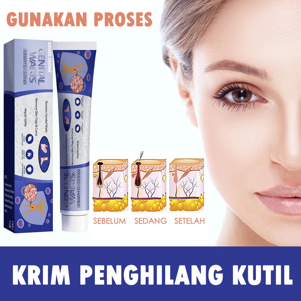 Jual Wart Removal Cream Repair And Clean Skin Tag Remover Menghilangkan ...
