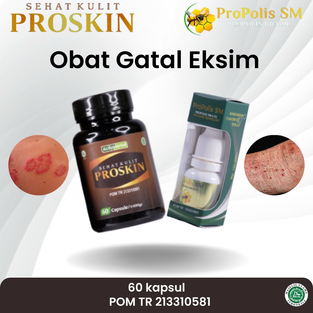 Jual ProPolis SM - Obat Eksim Kering, Eksim Di Kaki, Gatal Exsim, Eksim ...