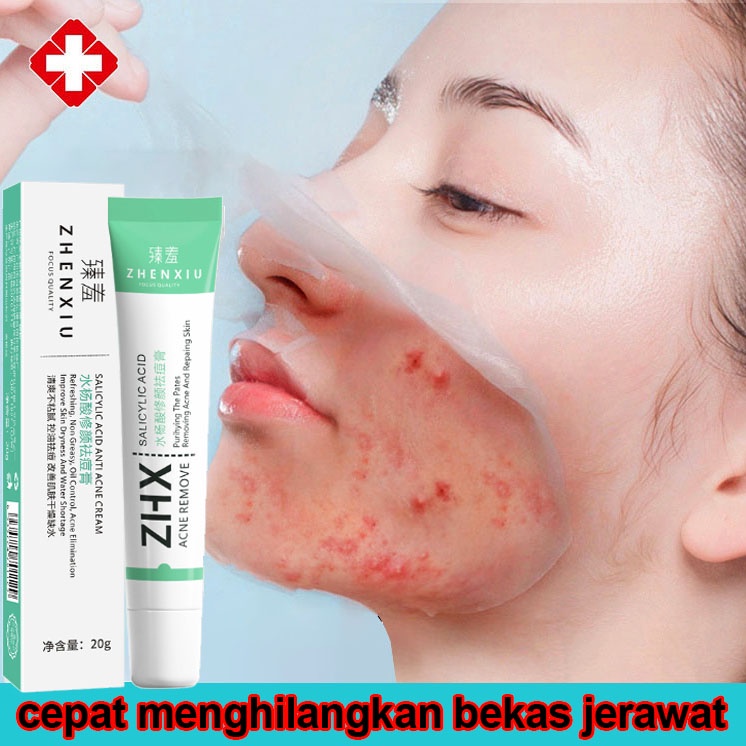 Jual Krim anti jerawat krim jerawat salep jerawat cream jerawat 20g gel ...