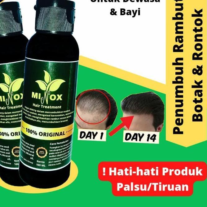 Jual [MINOX] Penumbuh Rambut Botak,Tipis dan Rontok Super Cepat ...