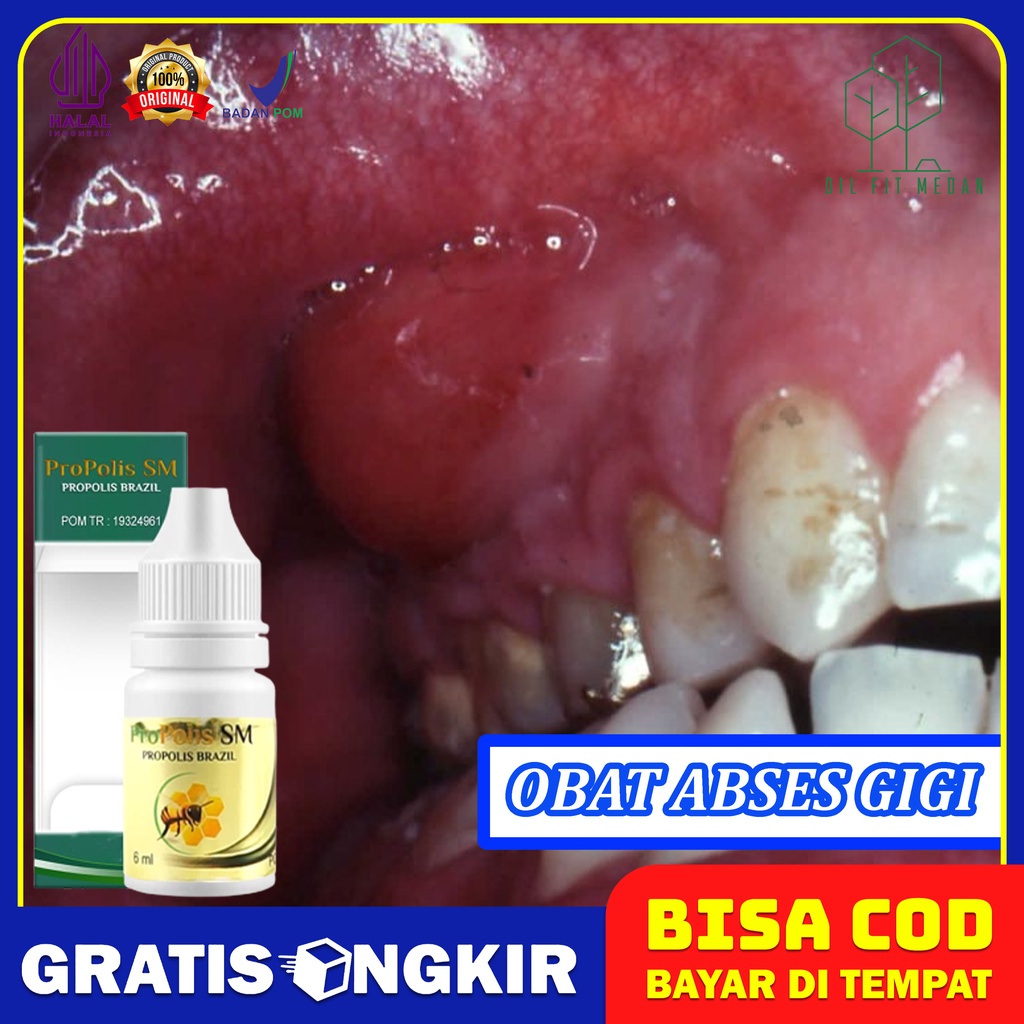 Jual Obat Abses Gigi Perikoronitis Radang Gusi Periodontitis Plak Gigi ...