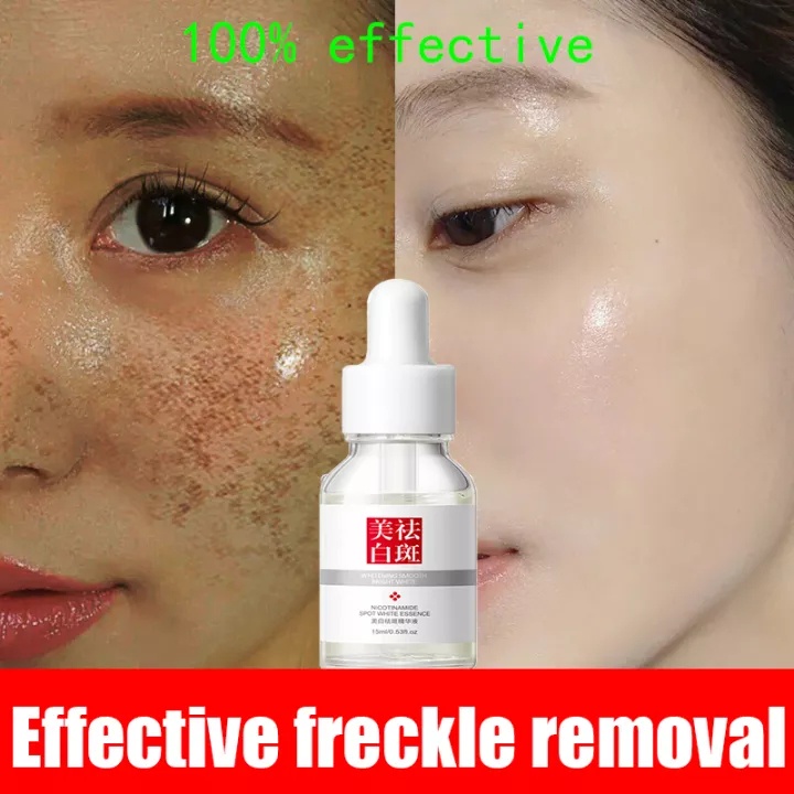 Jual Effective Freckle Serum Remove Dark Spots Witening Serum Fade Acne Scars Melasma Anti-Aging ...