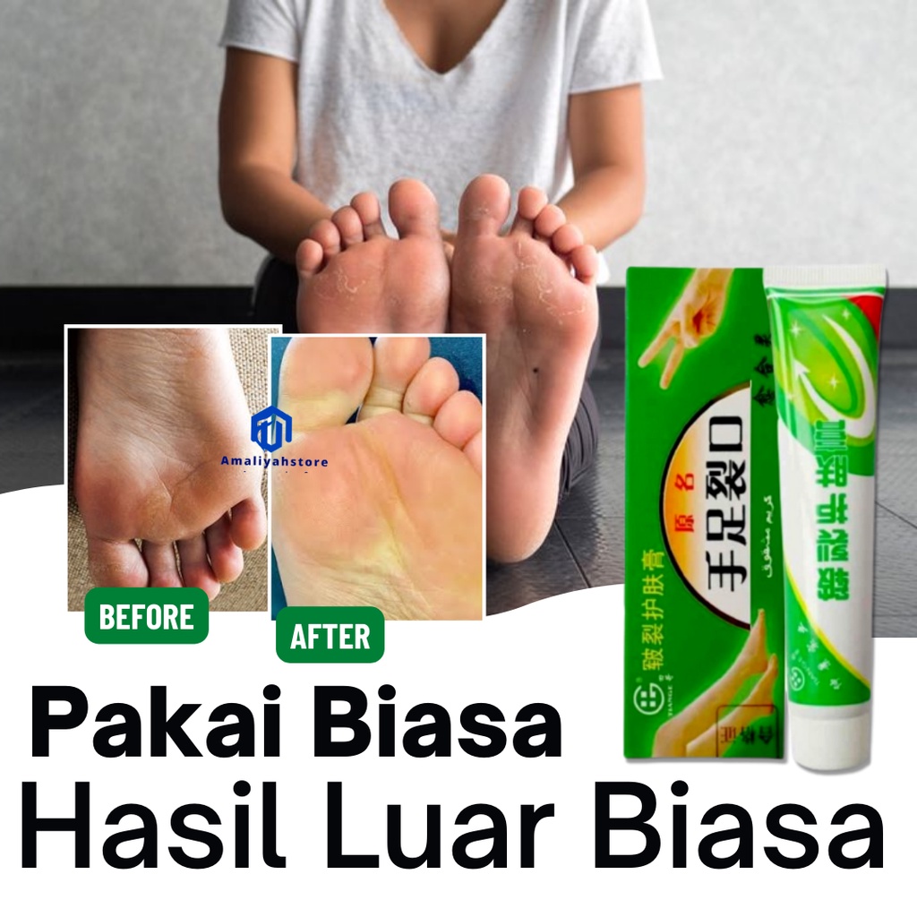 Jual Salep Kaki Rayapan Obat Gatal Telapak Kaki Bau Bolong Penghilang ...