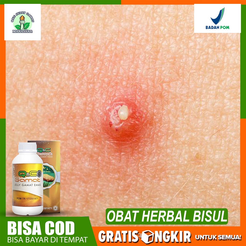 Jual Obat Oles Bisulan Cenang Bisul Bernanah Pengering Luka Bisul Qnc ...