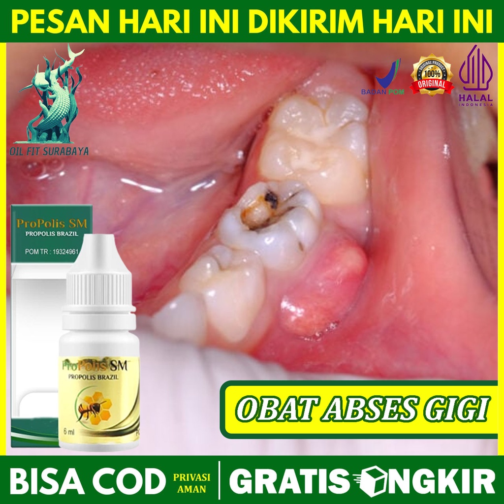 Jual Obat Abses Gigi Perikoronitis Radang Gusi Periodontitis Plak Gigi ...