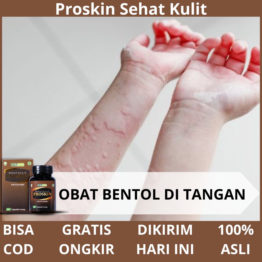 Jual Obat Bentol Tangan - Penghilang Bentol Bentol Gatal, Berair ...