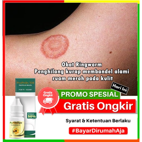 Jual Obat Ringworm, Penghilang kurap membandel alami, ruam merah pada ...
