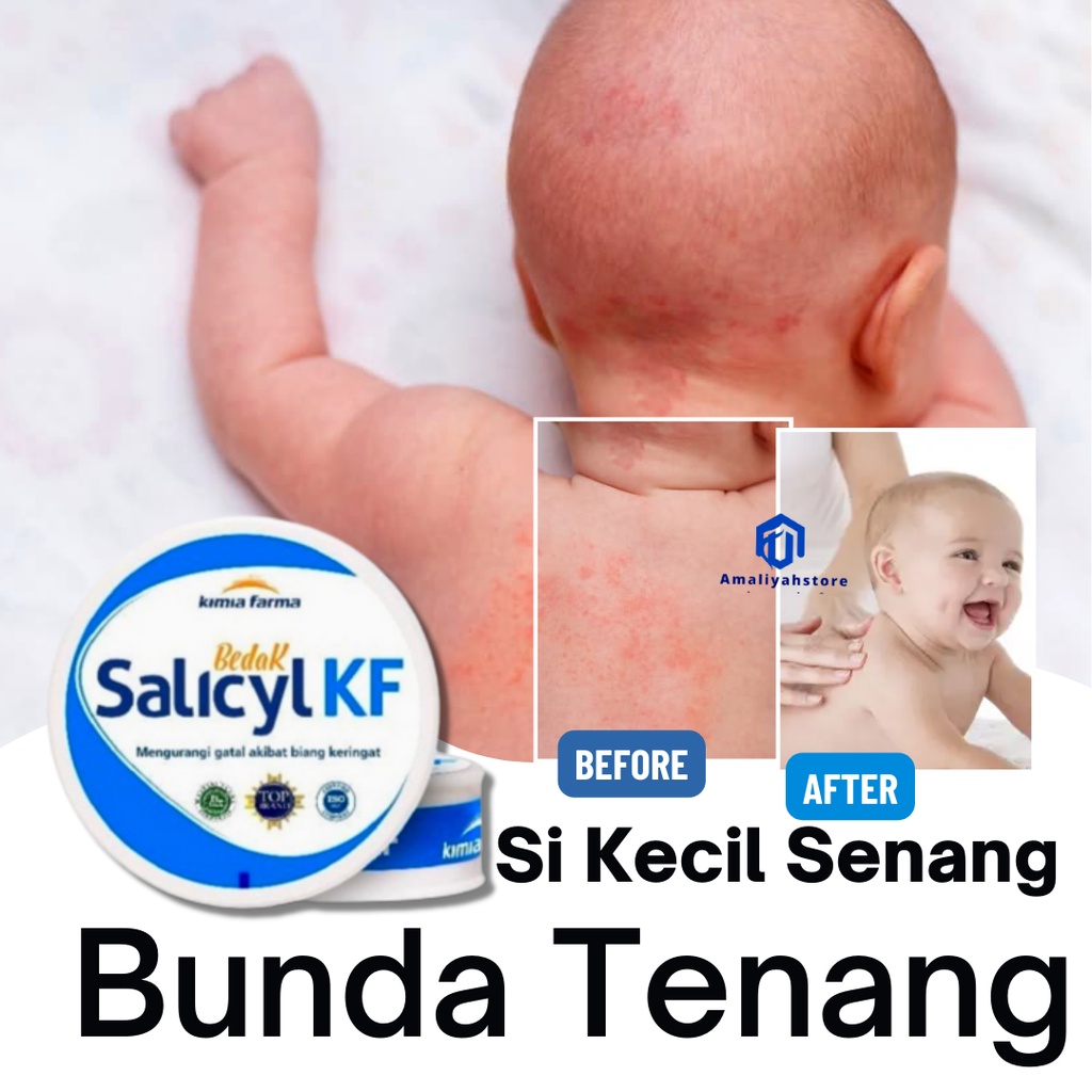 Jual Bedak Tabur Salicyl Kf Menthol Obat Untuk Gatal Biduran Biang ...