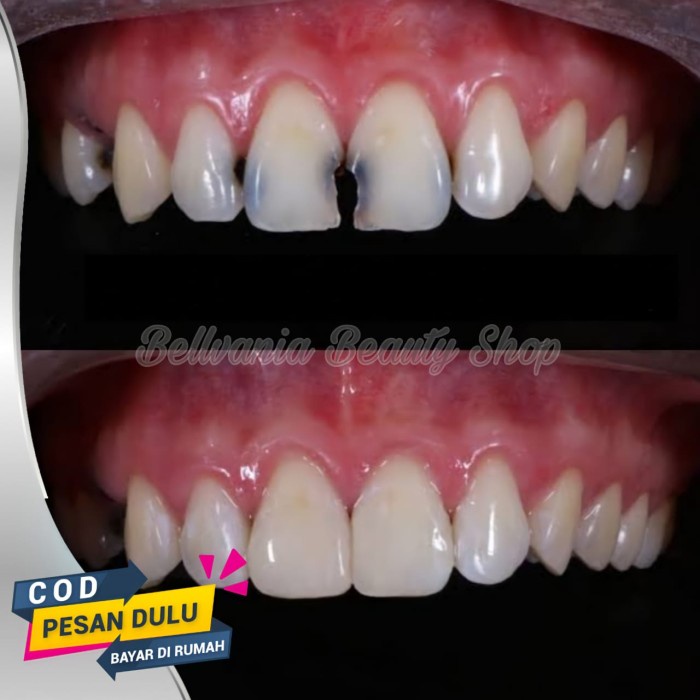 Jual Tambal gigi bolong depan tambal gigi patah lem tambal gigi TCI | Shopee Indonesia