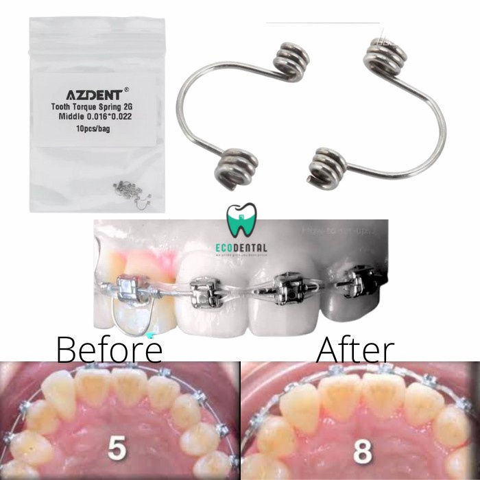 Jual Dental Torque Spring Labial Lingual Root Torquing Orthodontic ...