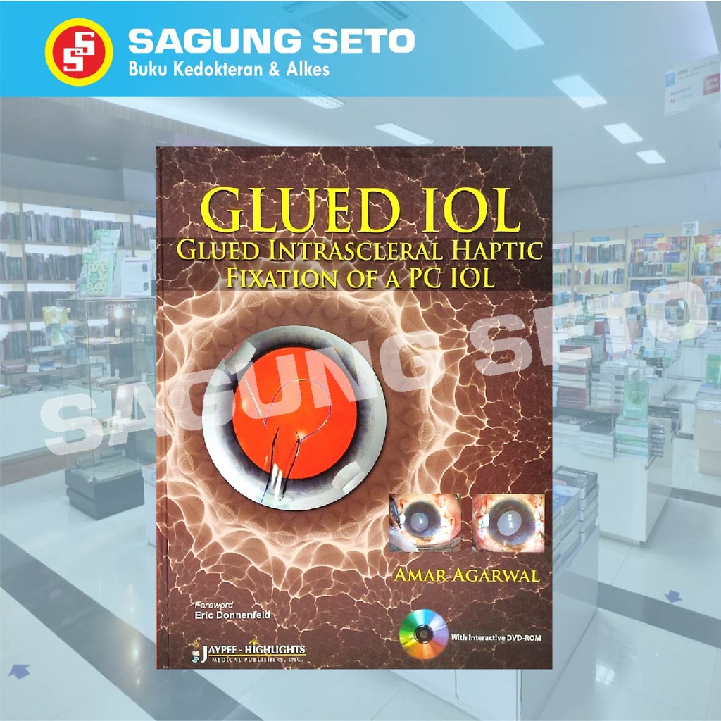 Jual BUKU GLUED IOL GLUED INTRASCLERAL HAPTIC FIXATION OF A PC IOL ...