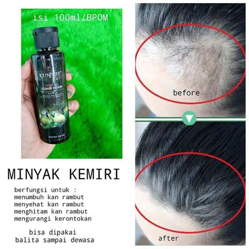 Jual Minyak Penumbuh Rambut Botak Pelebat Rambut Penghitam Uban Anti ...