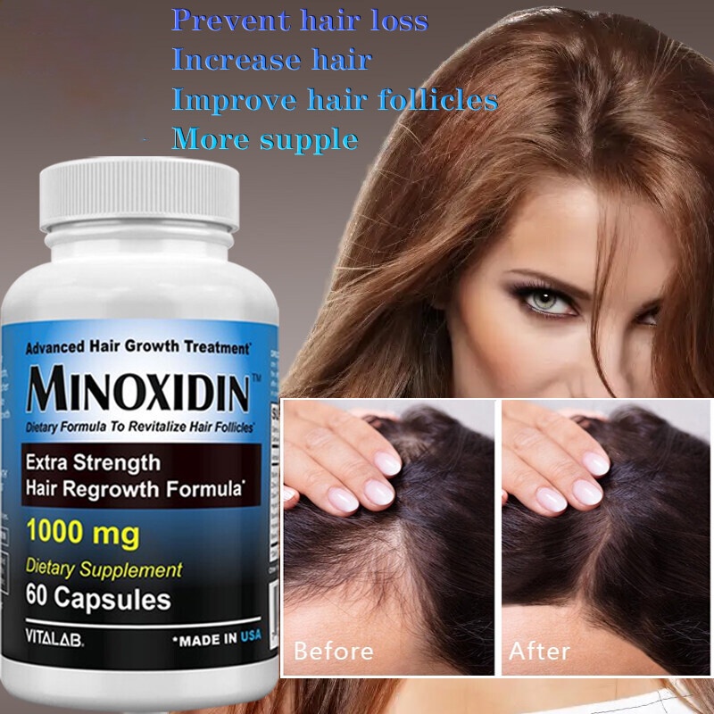 Jual Suplemen Vitamin Penumbuh Rambut Rontok 30 60 120 Capsules ...