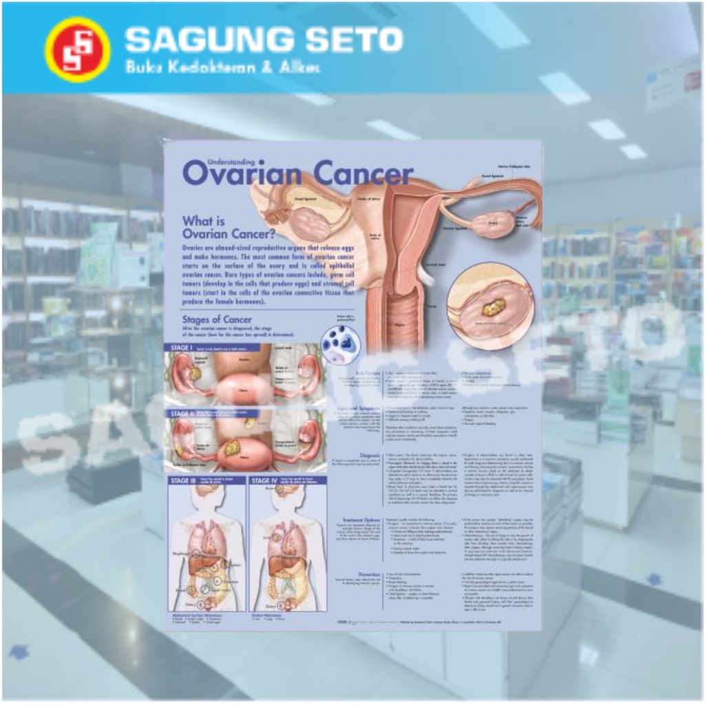 Jual POSTER UNDERSTANDING OVARIAN CANCER LAMINATED ( 2D ) | Shopee ...