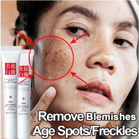 Jual Fuyan Whitening Freckle Cream Remove Dark Spots Anti Freckle Cream Niacinamide Fade ...